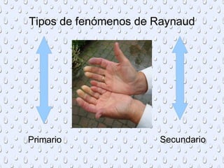Fenómeno de Raynaud | ODP | Diseases and Conditions | Medical Health