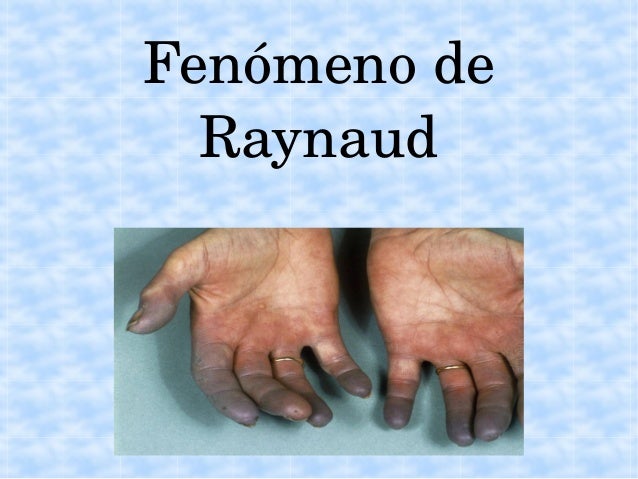 Fenómeno de Raynaud