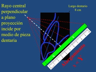 Fenómenos Proyeccionales Específicos. Intraoral Periapical | PPTX