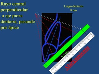 Fenómenos Proyeccionales Específicos. Intraoral Periapical | PPTX