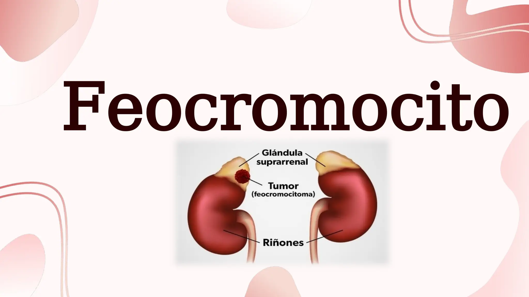 FEOCROMOCITOMA..pptxUn feocromocitoma es un tumor poco común que se ...
