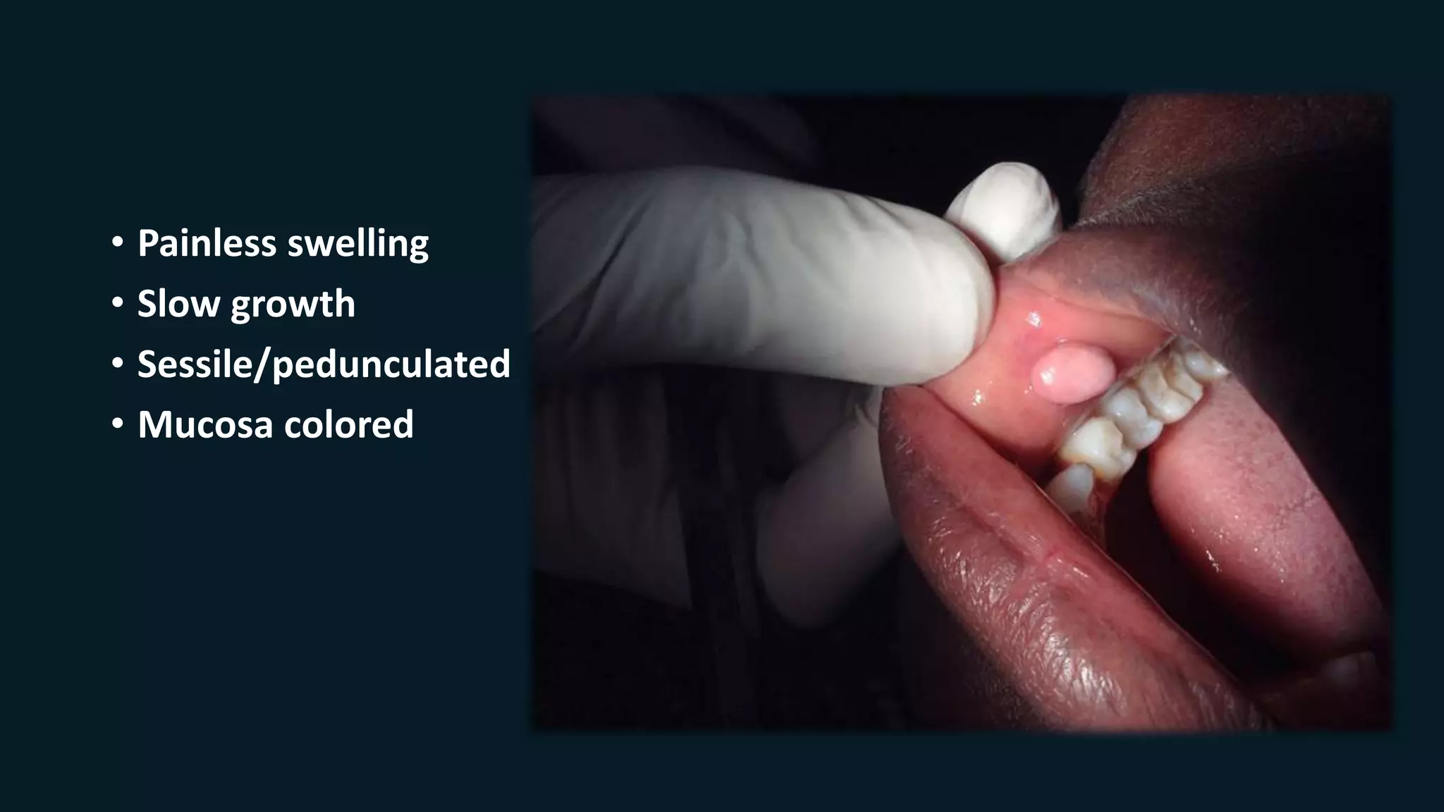 Oral Fibro-Epithelial Polyp | PPTX | Dental Health | Diseases and ...