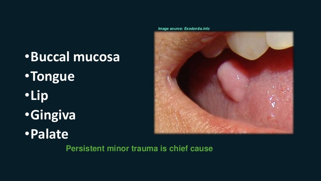 Oral Fibro-Epithelial Polyp