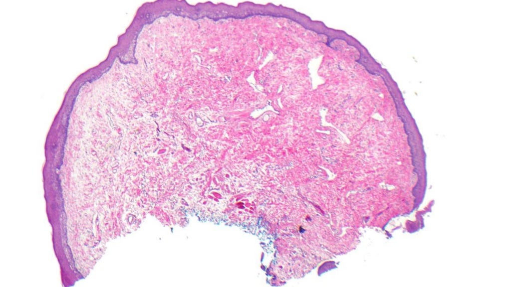 Oral Fibro-Epithelial Polyp