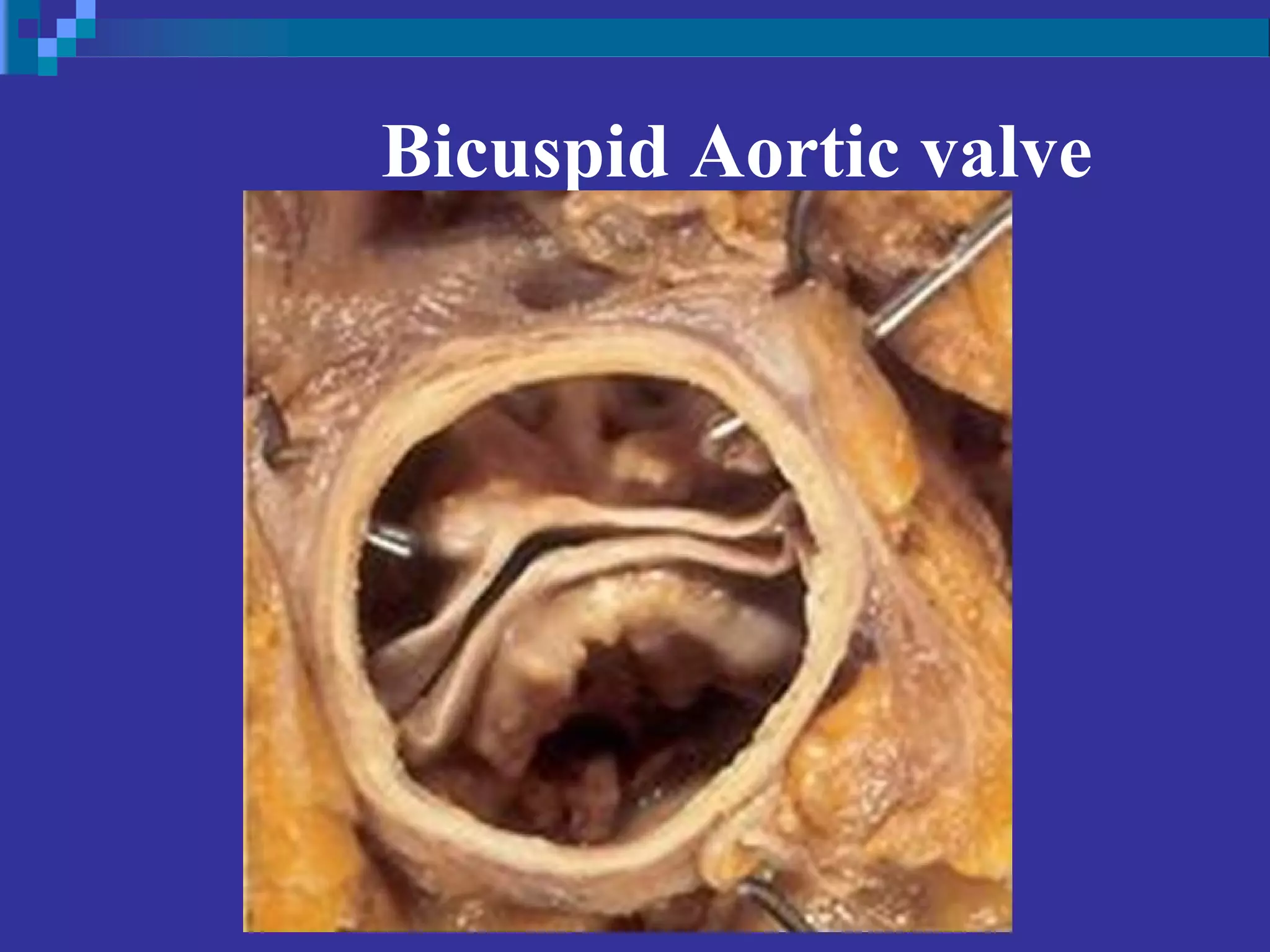 Echo assessment of Aortic valve disease, Dr Ferdous assistant registrar ...
