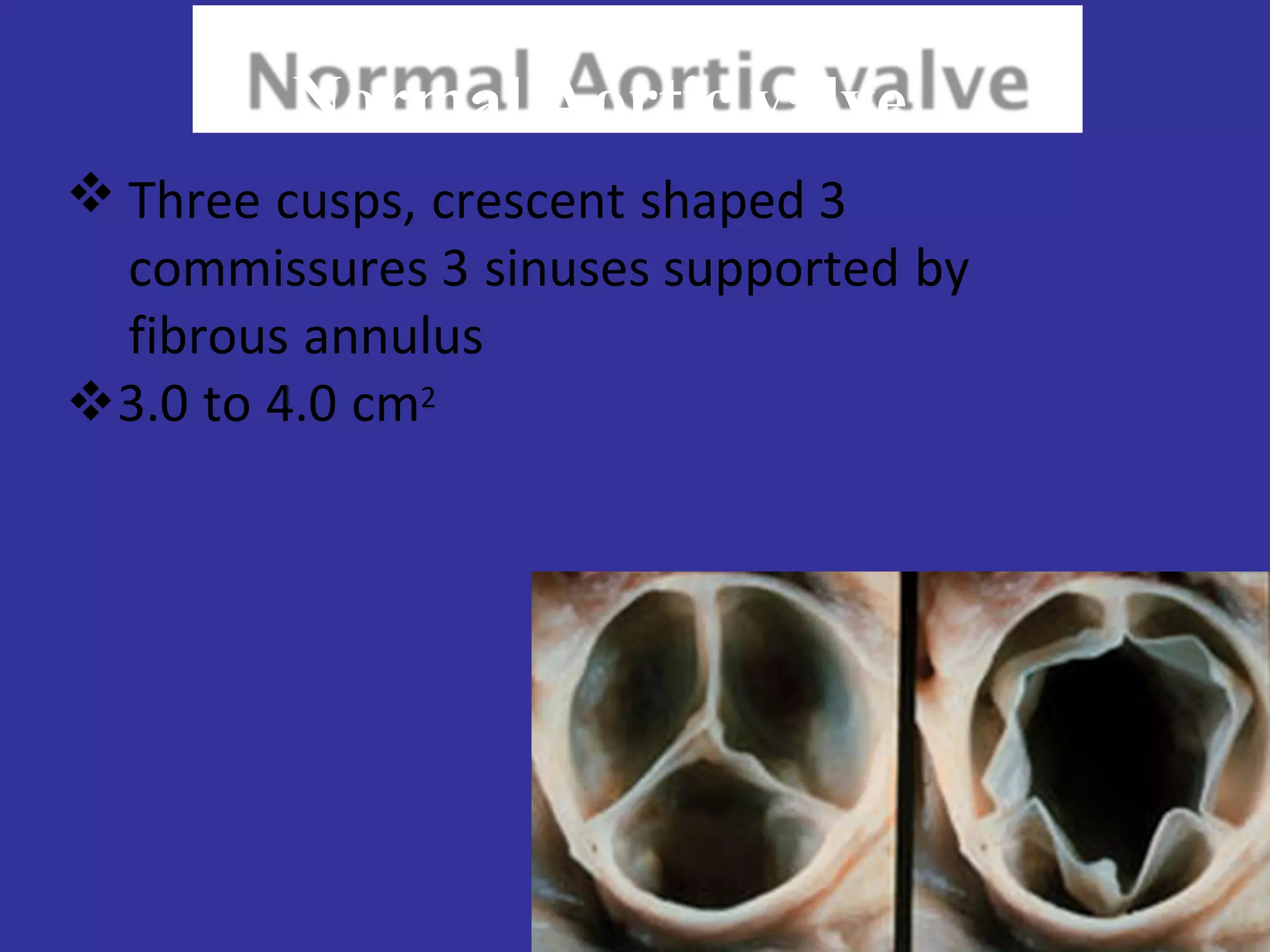 Echo assessment of Aortic valve disease, Dr Ferdous assistant registrar ...