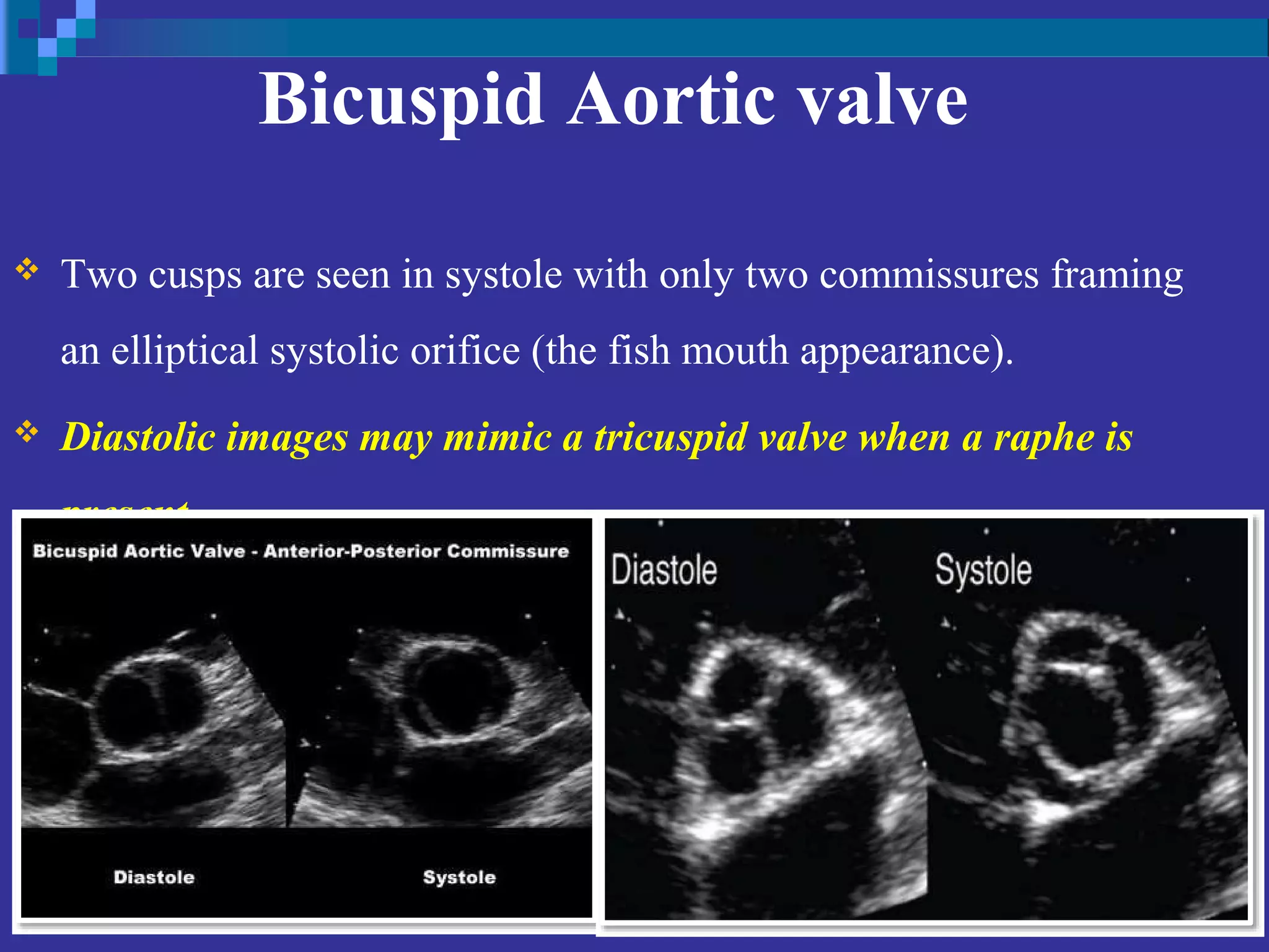 Echo assessment of Aortic valve disease, Dr Ferdous assistant registrar ...