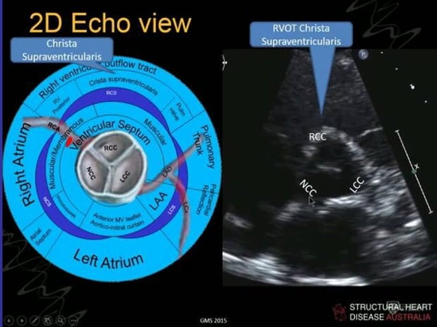 Echo assessment of Aortic valve disease, Dr Ferdous assistant registrar ...