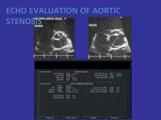 Echo assessment of Aortic valve disease, Dr Ferdous assistant registrar ...