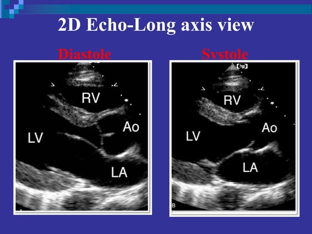 Echo assessment of Aortic valve disease, Dr Ferdous assistant registrar ...