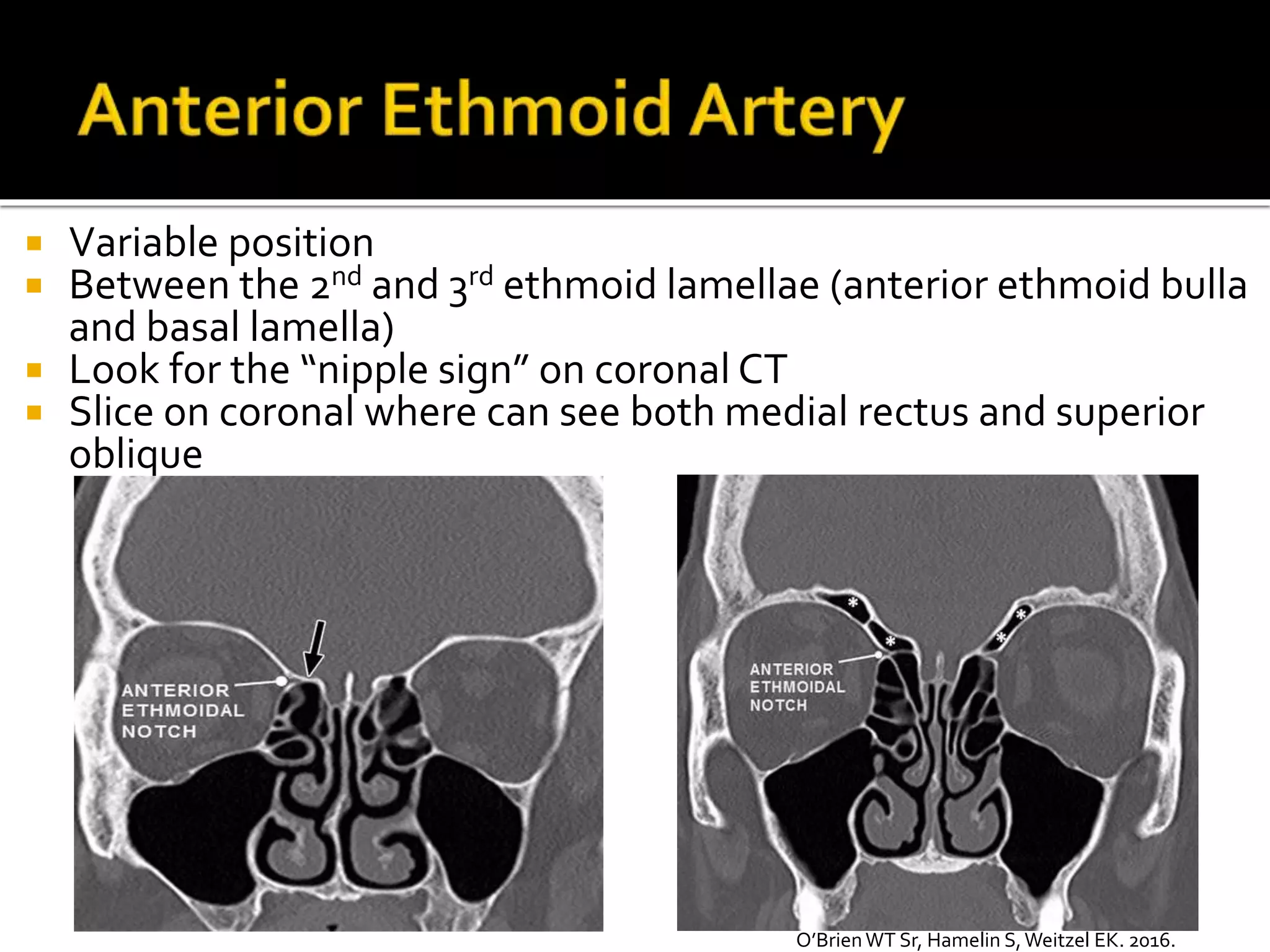 Sinus Anatomy Lectures: Western Residents Advanced Endsocopic Sinus ...