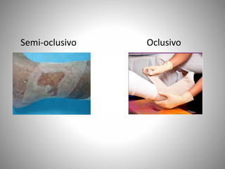 Feridas e Curativos | PPT