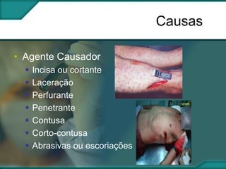 Feridas e curativos | PPTX