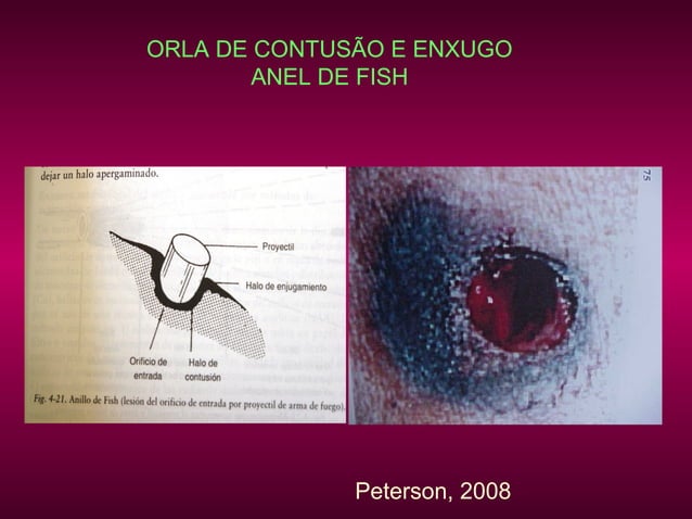 Ferimento por arma de fogo