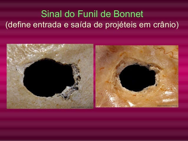 Ferimento por arma de fogo
