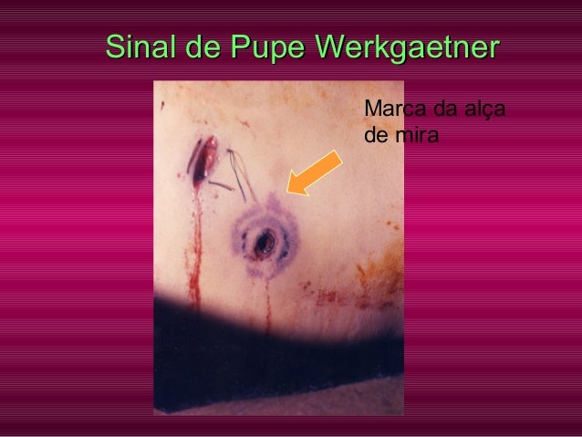 Ferimento por arma de fogo