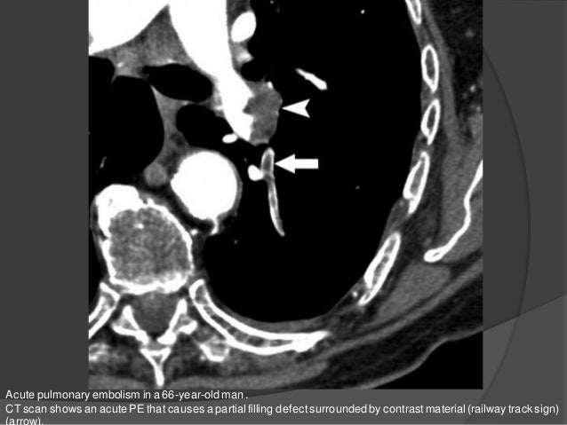 Imaging of pulmonary embolism