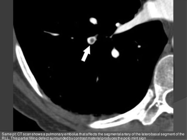 Imaging of pulmonary embolism