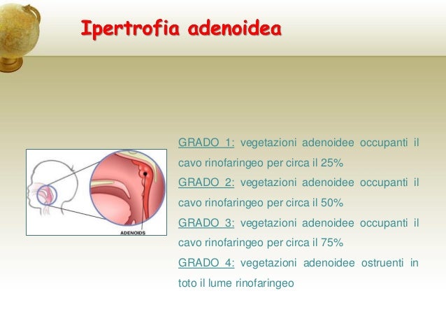20181110 - Ferrero - Adenoidite ipertrofica e il bambino allergico