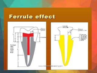 Ferrule 3 | PPT