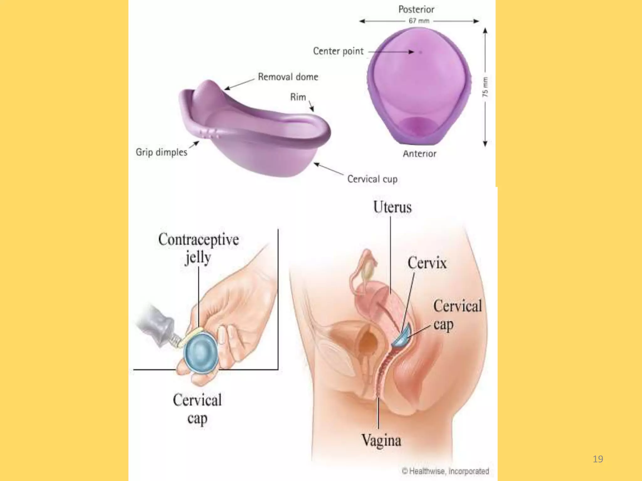 Fertility control (Contraception) | PPTX