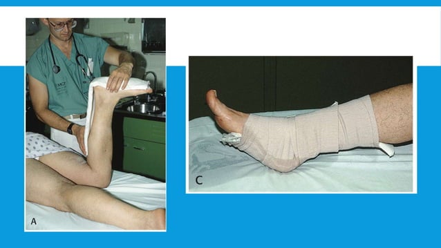 INMOVILIZACIONES CON FERULA DE YESO.pptx
