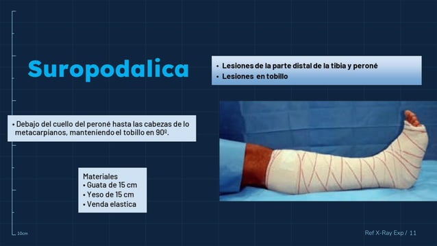 FERULAS E INMOVILIZACIONES.pdf, traumatología y ortopediA | PDF ...