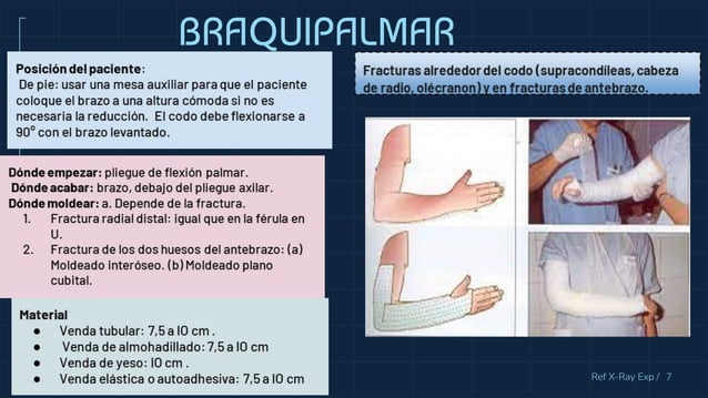FERULAS E INMOVILIZACIONES.pdf, traumatología y ortopediA | PDF ...