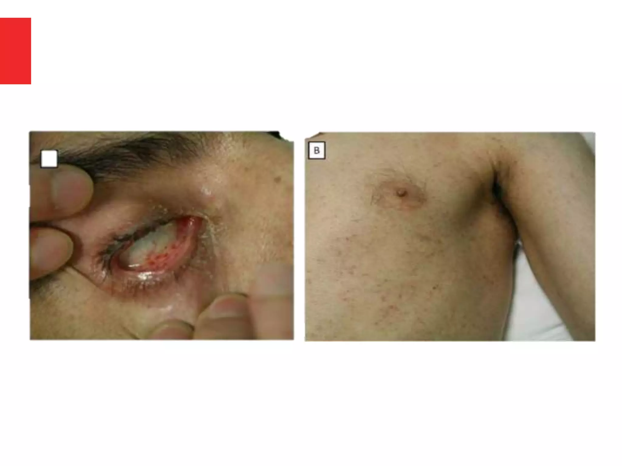 Fat Embolisum Syndrome | PPTX