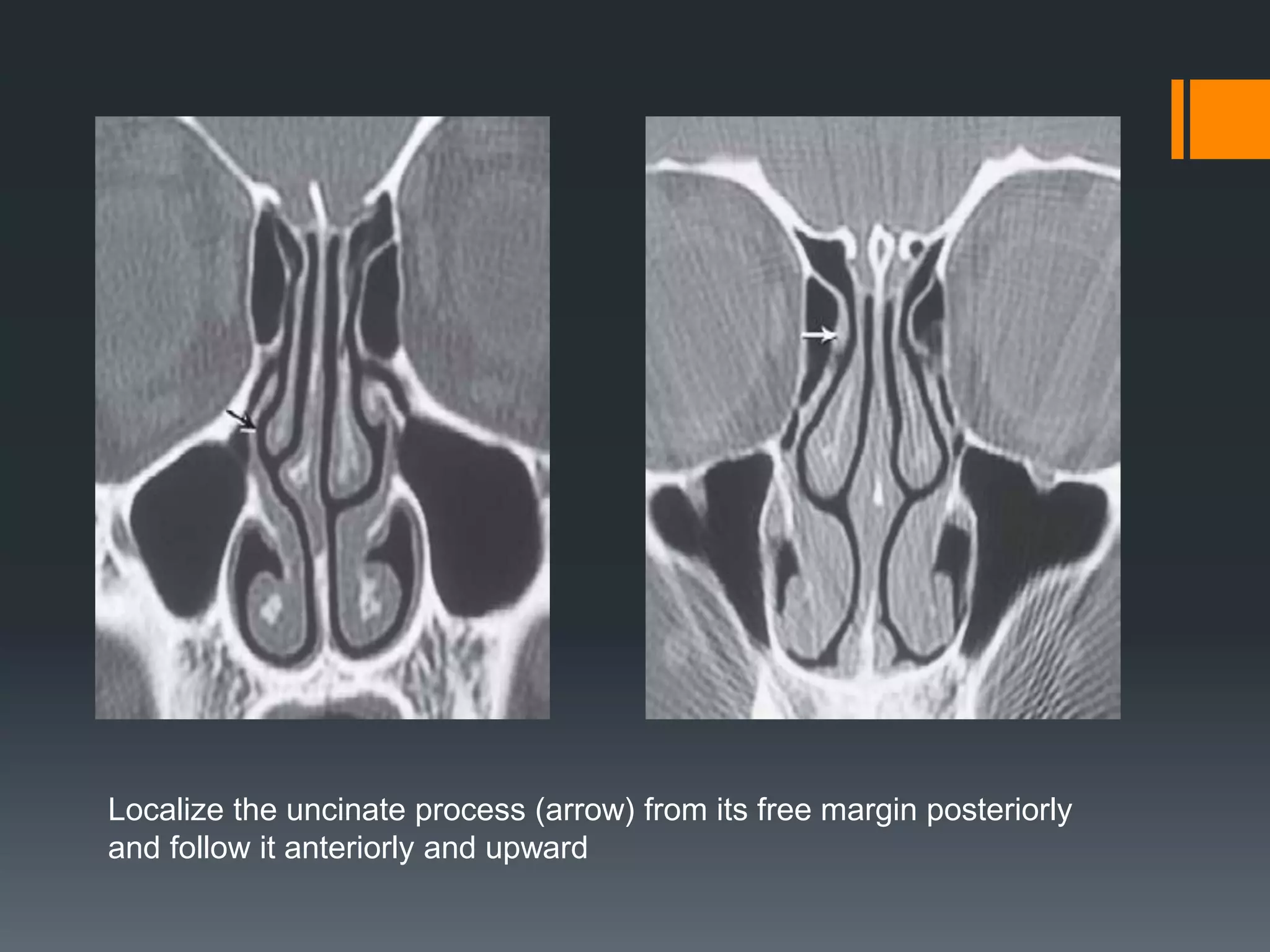 FESS - Functional endoscopic sinus surgery | PPTX