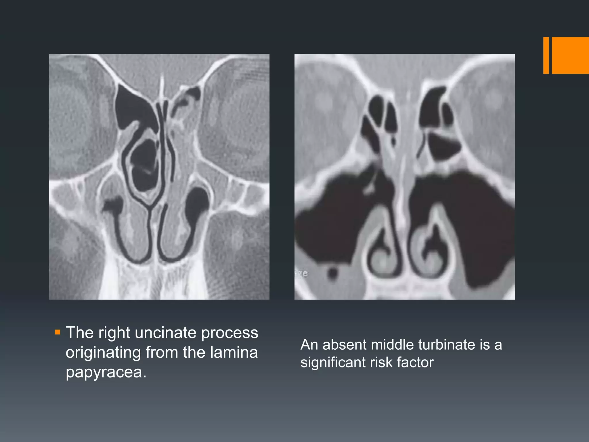 FESS - Functional endoscopic sinus surgery | PPTX