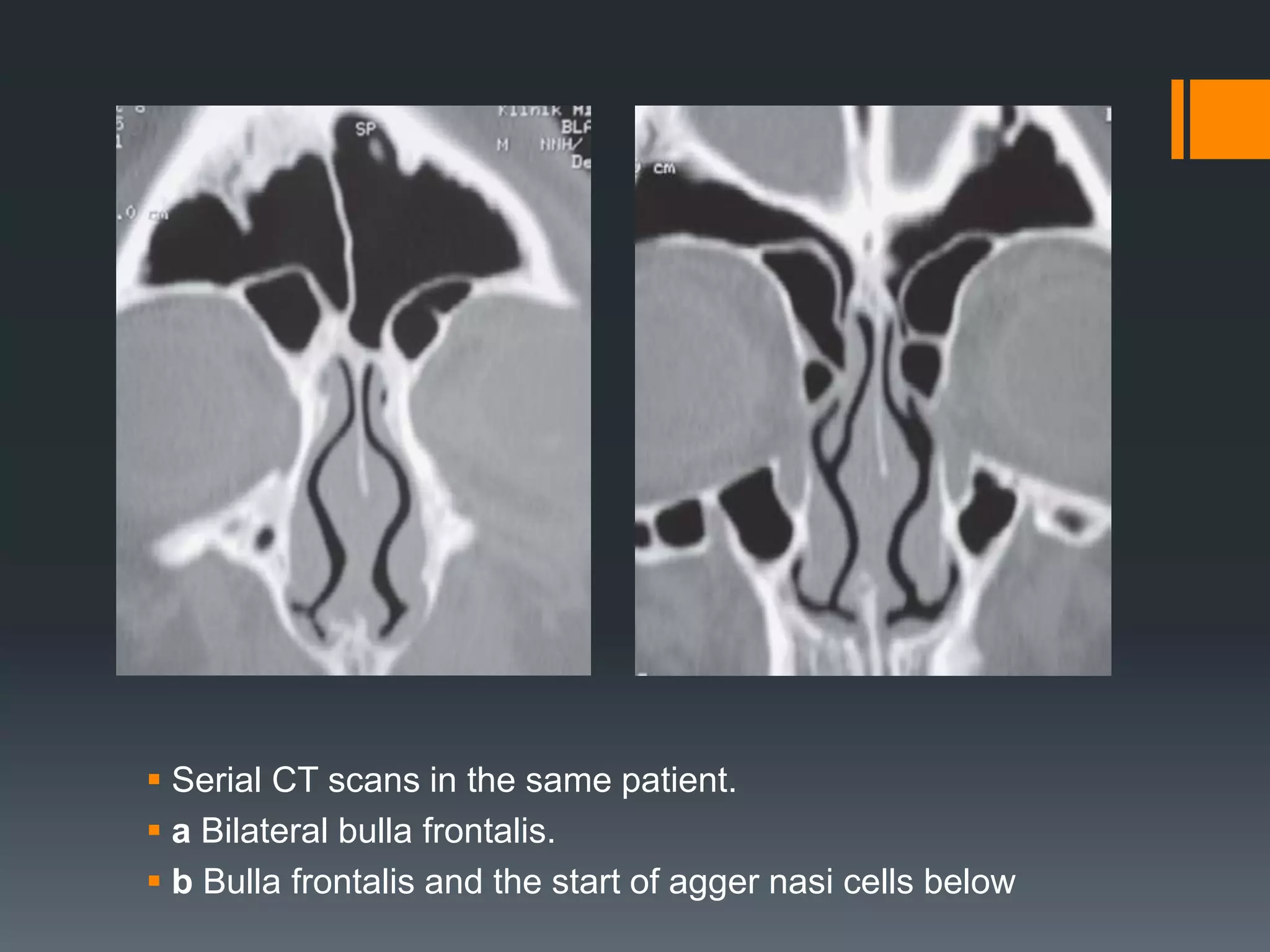 FESS - Functional endoscopic sinus surgery | PPTX
