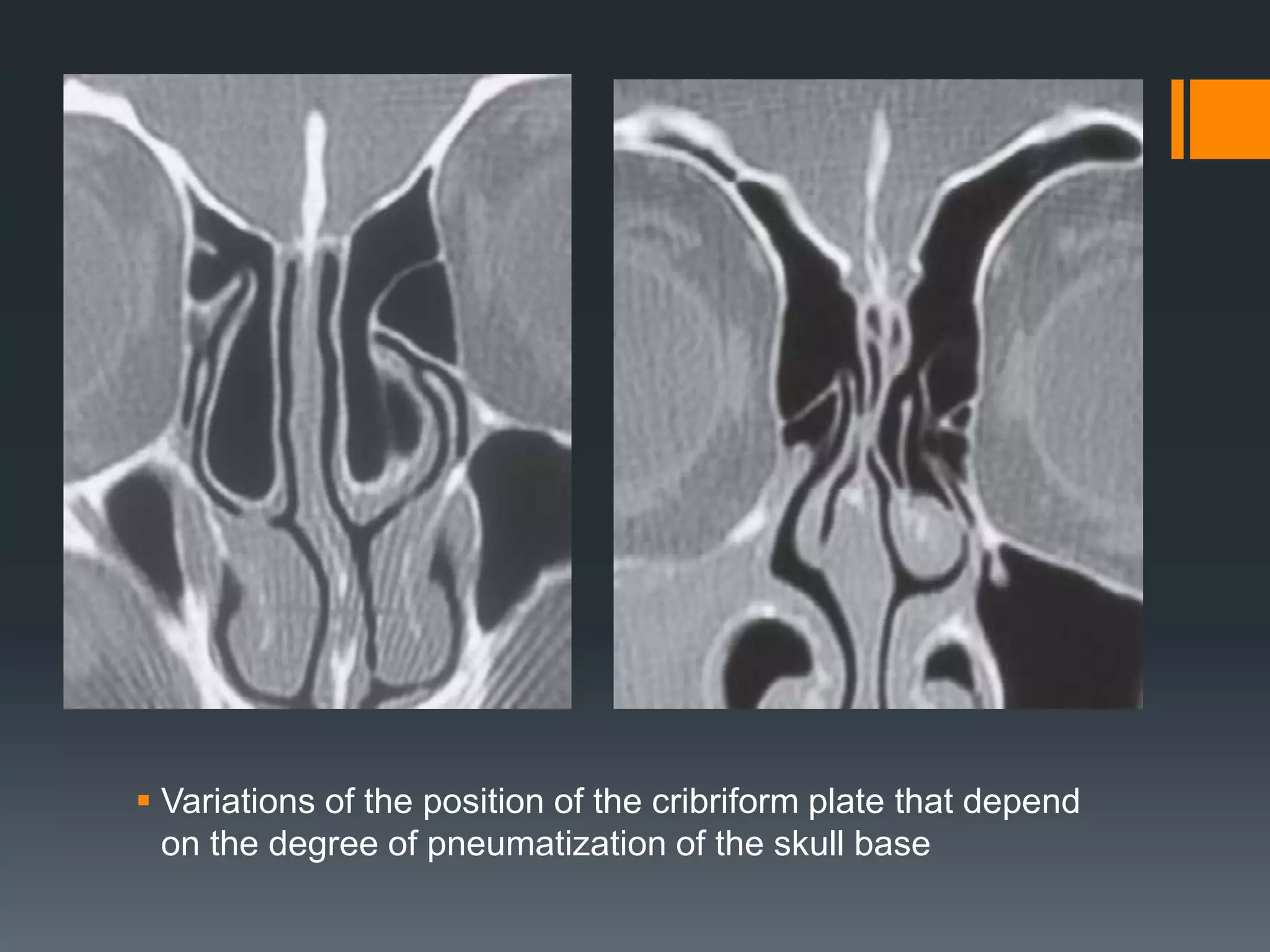 FESS - Functional endoscopic sinus surgery | PPTX