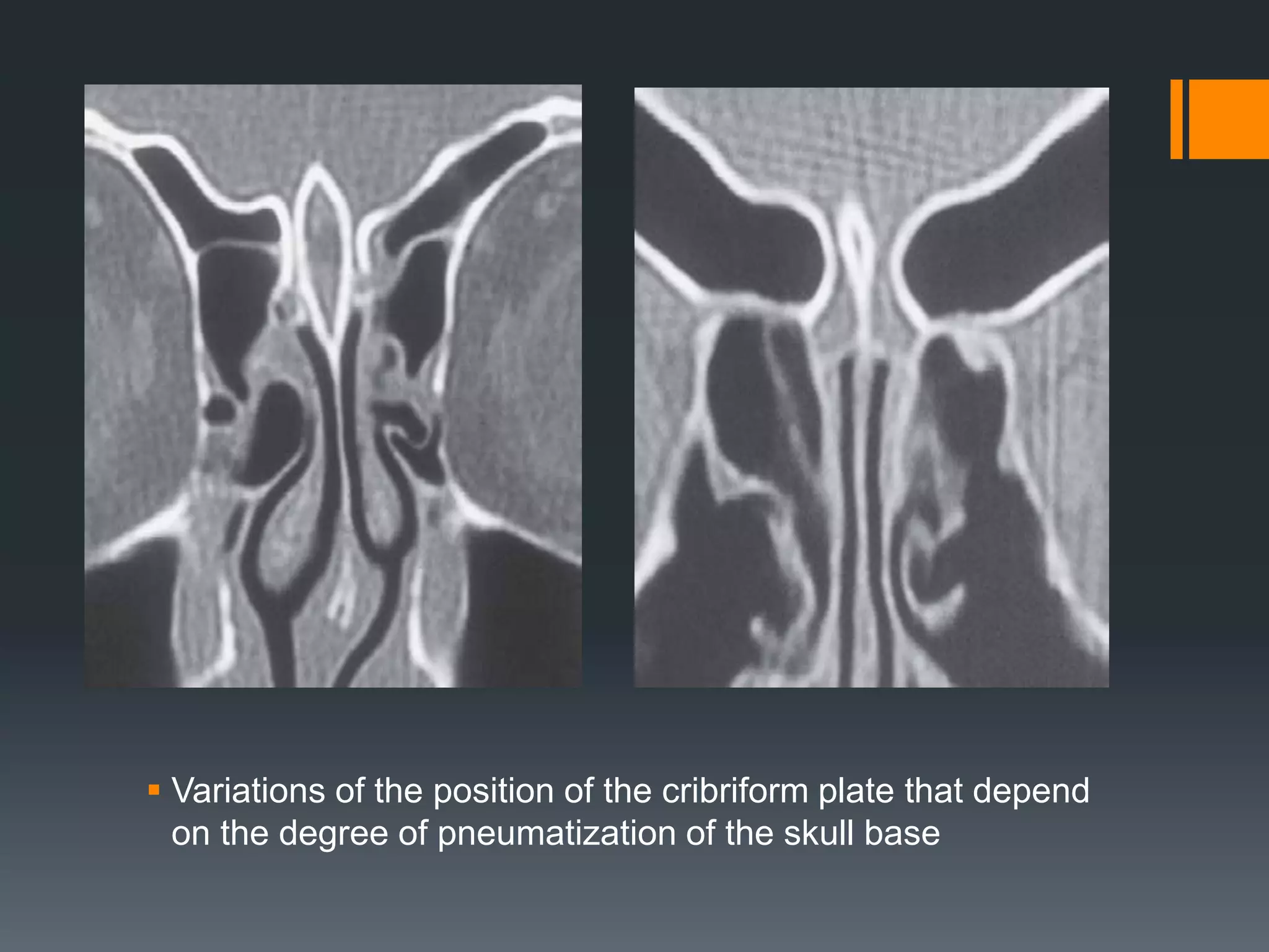 FESS - Functional endoscopic sinus surgery | PPTX