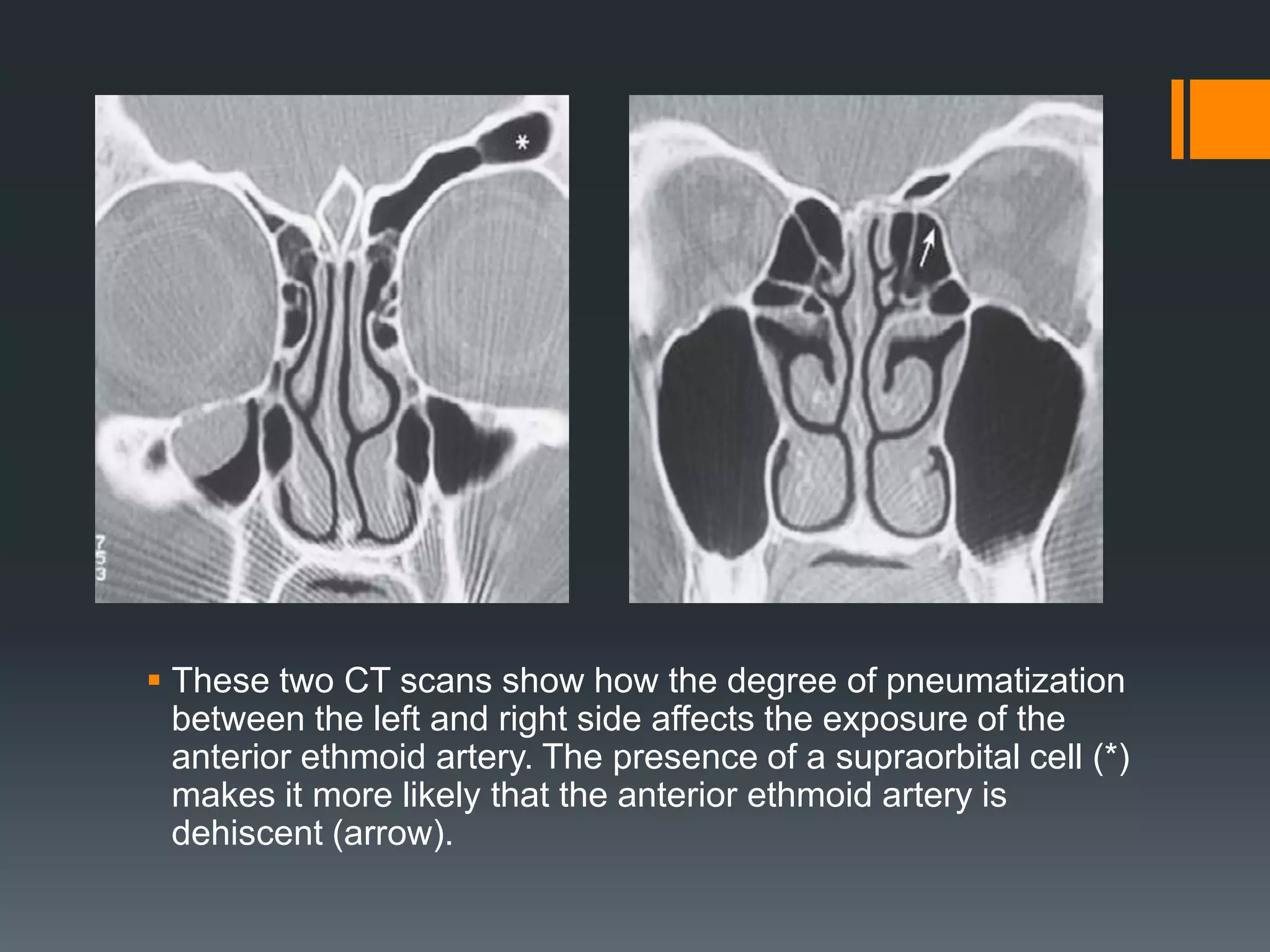 FESS - Functional endoscopic sinus surgery | PPTX