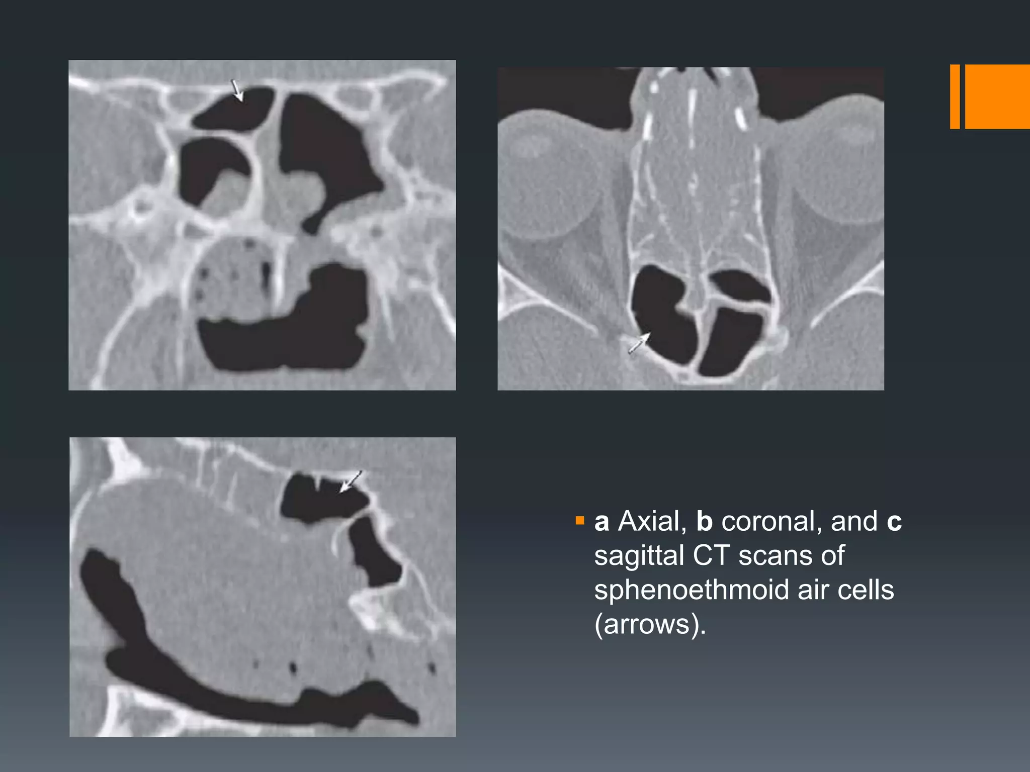 FESS - Functional endoscopic sinus surgery | PPTX