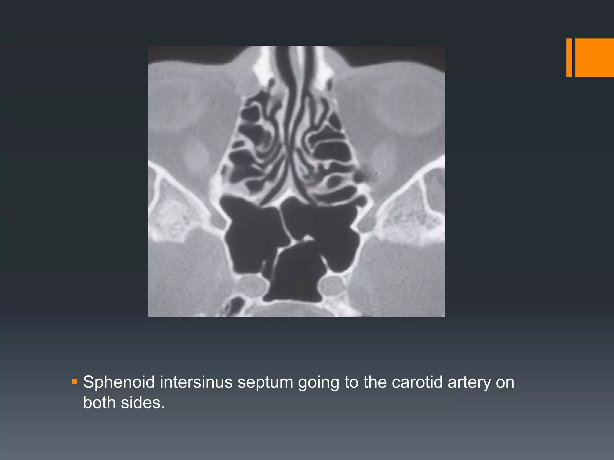 FESS - Functional endoscopic sinus surgery | PPTX