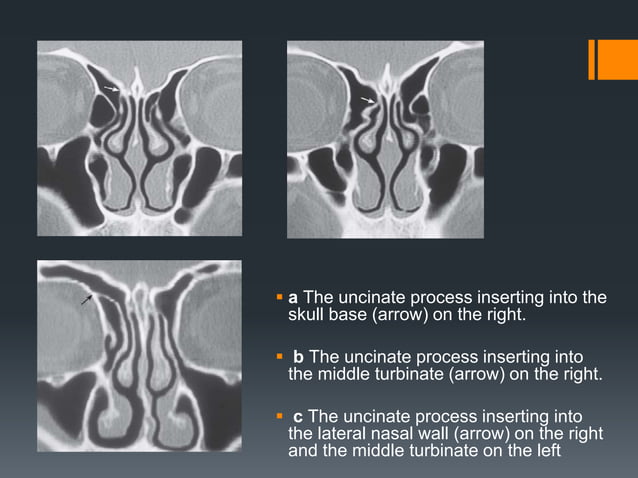 FESS - Functional endoscopic sinus surgery | PPTX