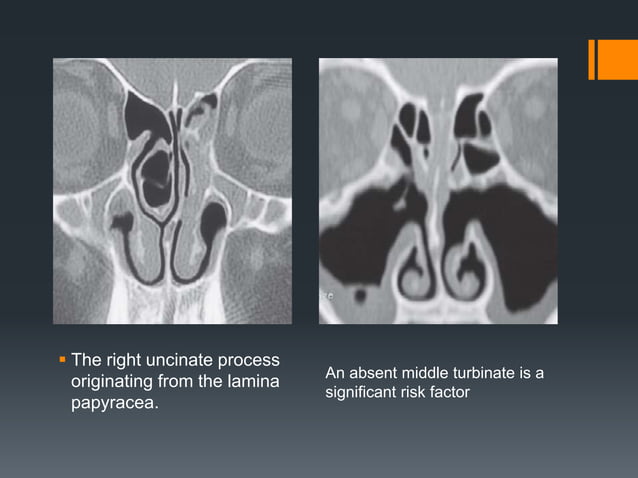 FESS - Functional endoscopic sinus surgery | PPTX