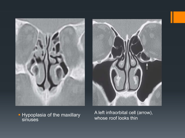 FESS - Functional endoscopic sinus surgery | PPTX