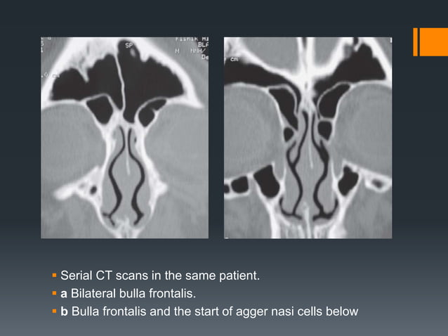 FESS - Functional endoscopic sinus surgery | PPTX
