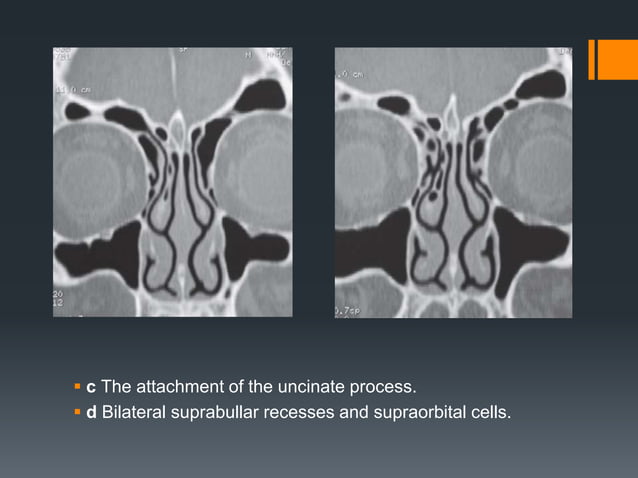 FESS - Functional endoscopic sinus surgery | PPTX