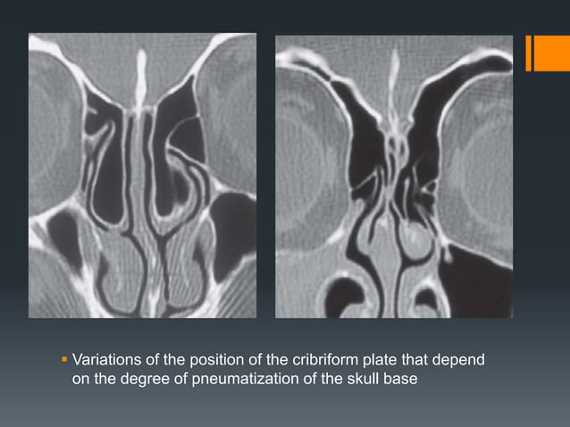 FESS - Functional endoscopic sinus surgery | PPTX
