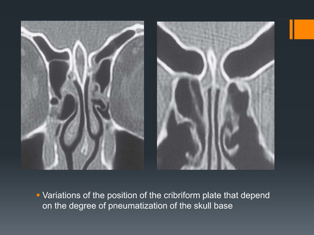 FESS - Functional endoscopic sinus surgery | PPTX