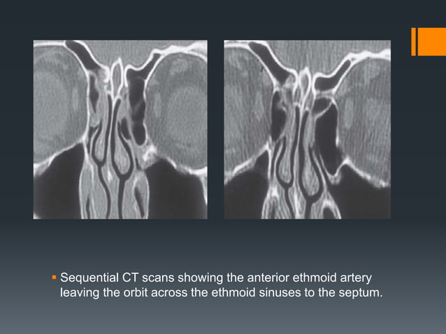 FESS - Functional endoscopic sinus surgery | PPTX