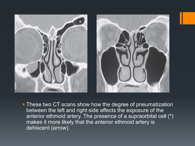 FESS - Functional endoscopic sinus surgery | PPTX