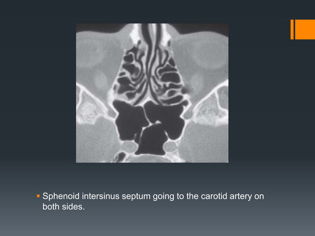 FESS - Functional endoscopic sinus surgery | PPTX