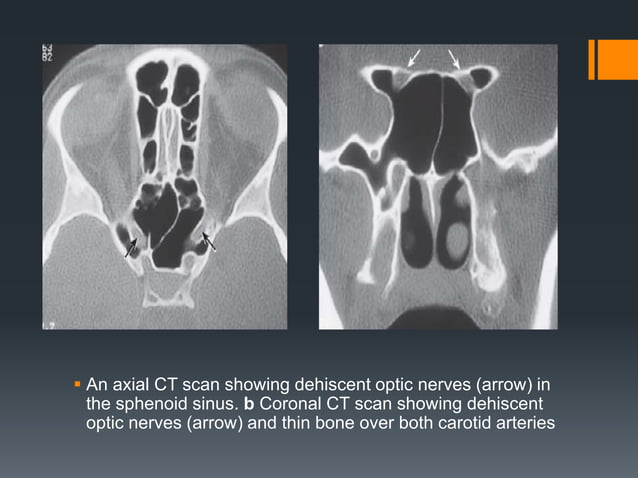 FESS - Functional endoscopic sinus surgery | PPTX