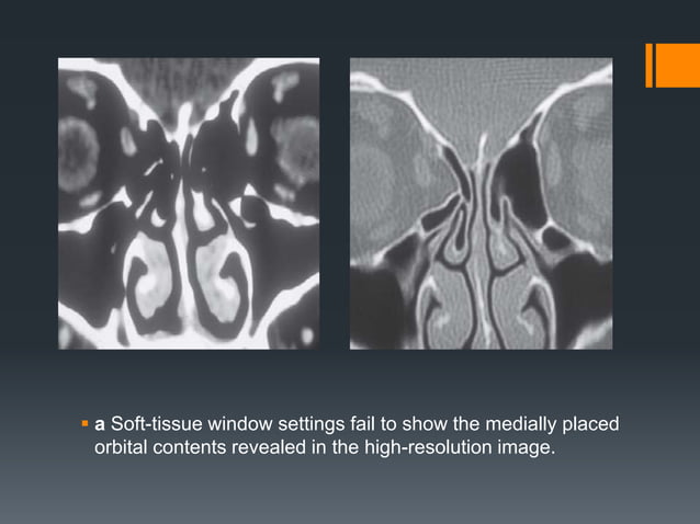 FESS - Functional endoscopic sinus surgery | PPTX