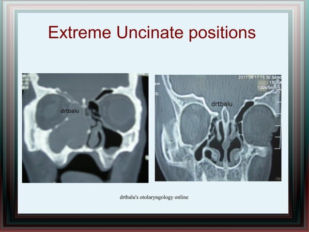 Fess complications | ODP | Ear, Nose and Throat Conditions | Diseases ...